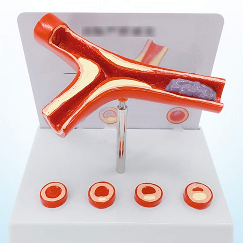 Buy XIEJI Arteriosclerosis Model Lesion Thrombosis Model Arterial ...