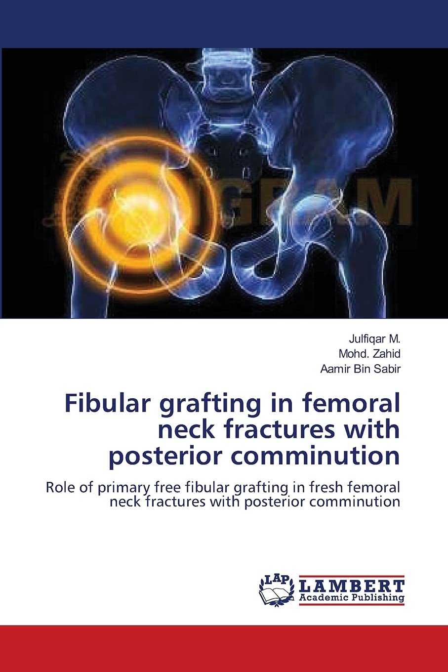 Fibular Grafting In Femoral Neck Fractures With Posterior Comminution ...