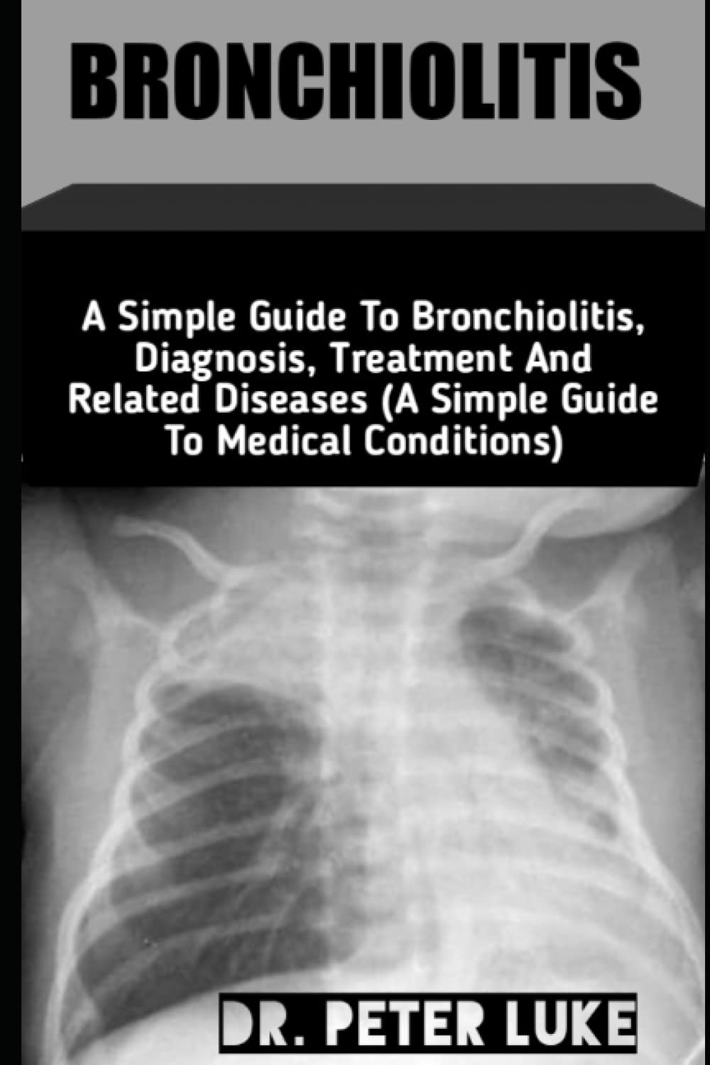 Buy BRONCHIOLITIS: A Simple Guide to Bronchiolitis, Diagnosis , and ...