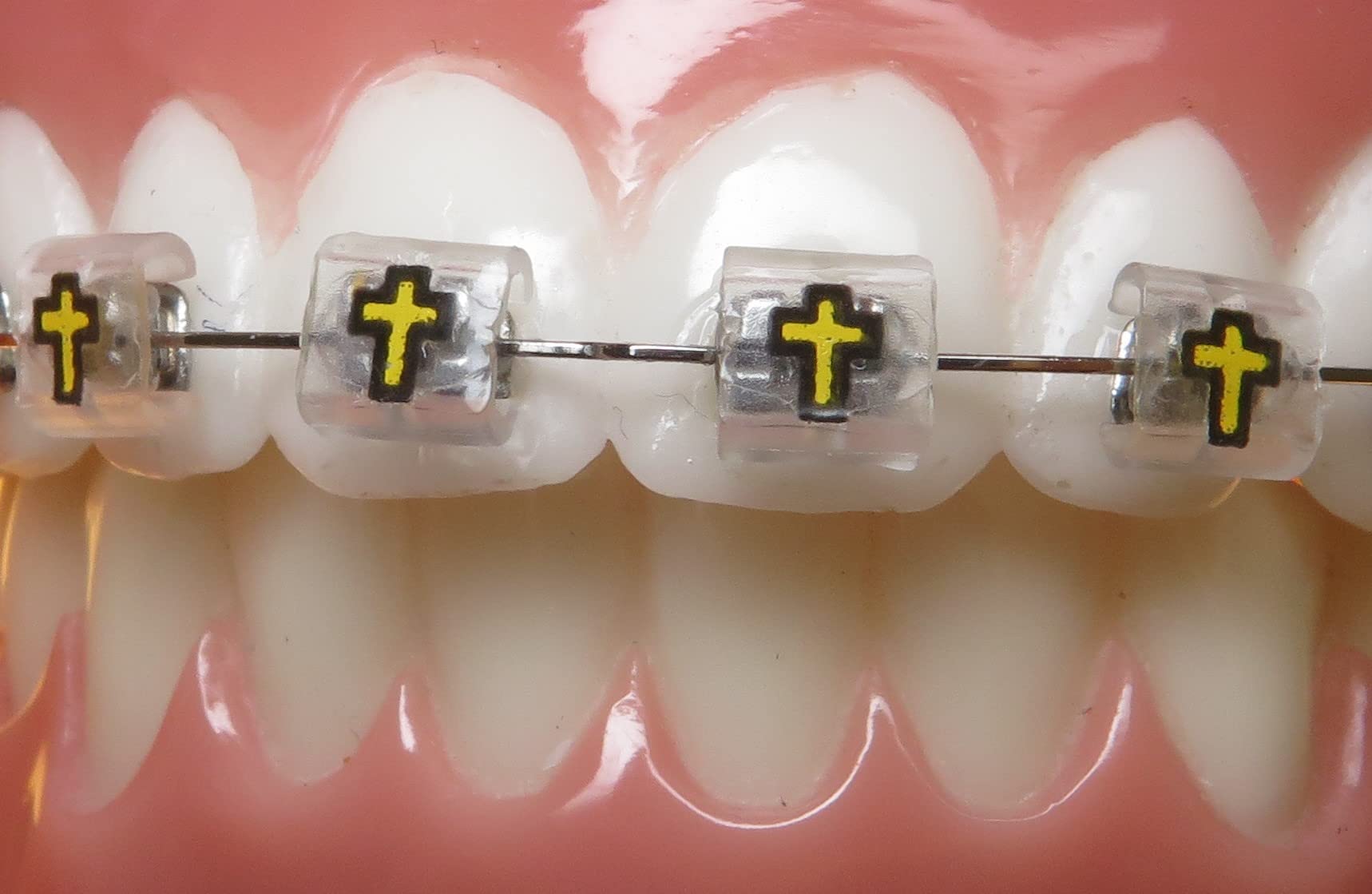 Amazon.com : Snapcaps Braces Bumper Cover, Orthodontic Bracket Wax ...