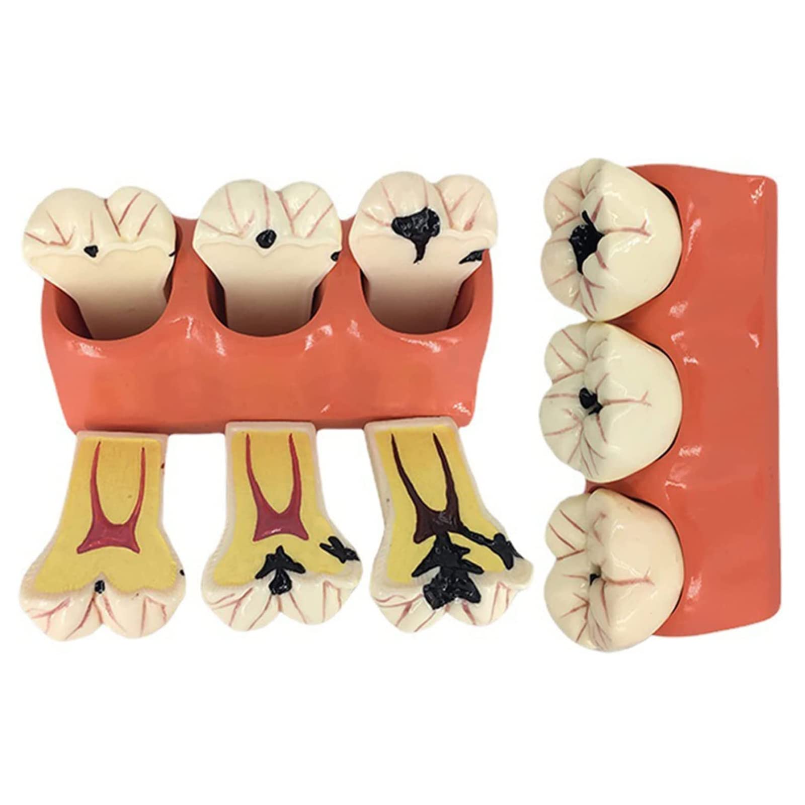 Tooth Model 4times Caries Decomposition Model Teeth Pathological Caries ...