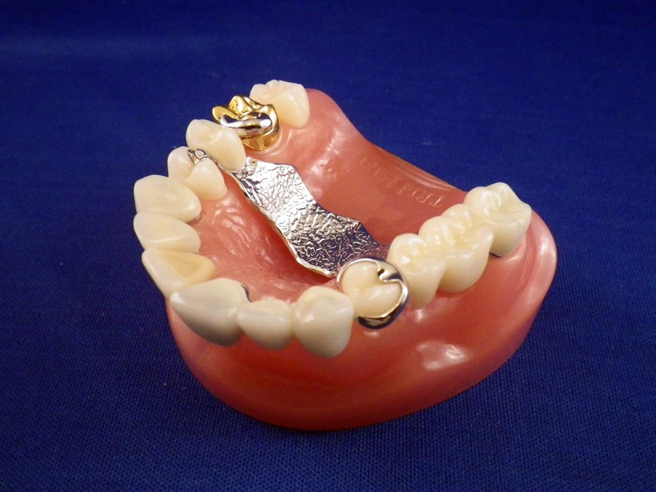 Removable Partials Clasp Design