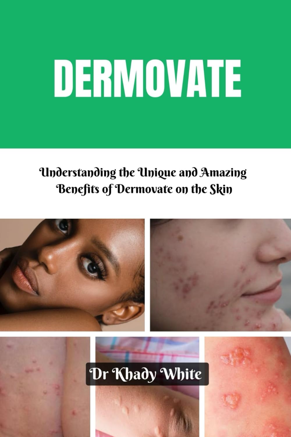 Dermovate Understanding The Unique And Amazing Benefits Of Dermovate On ...