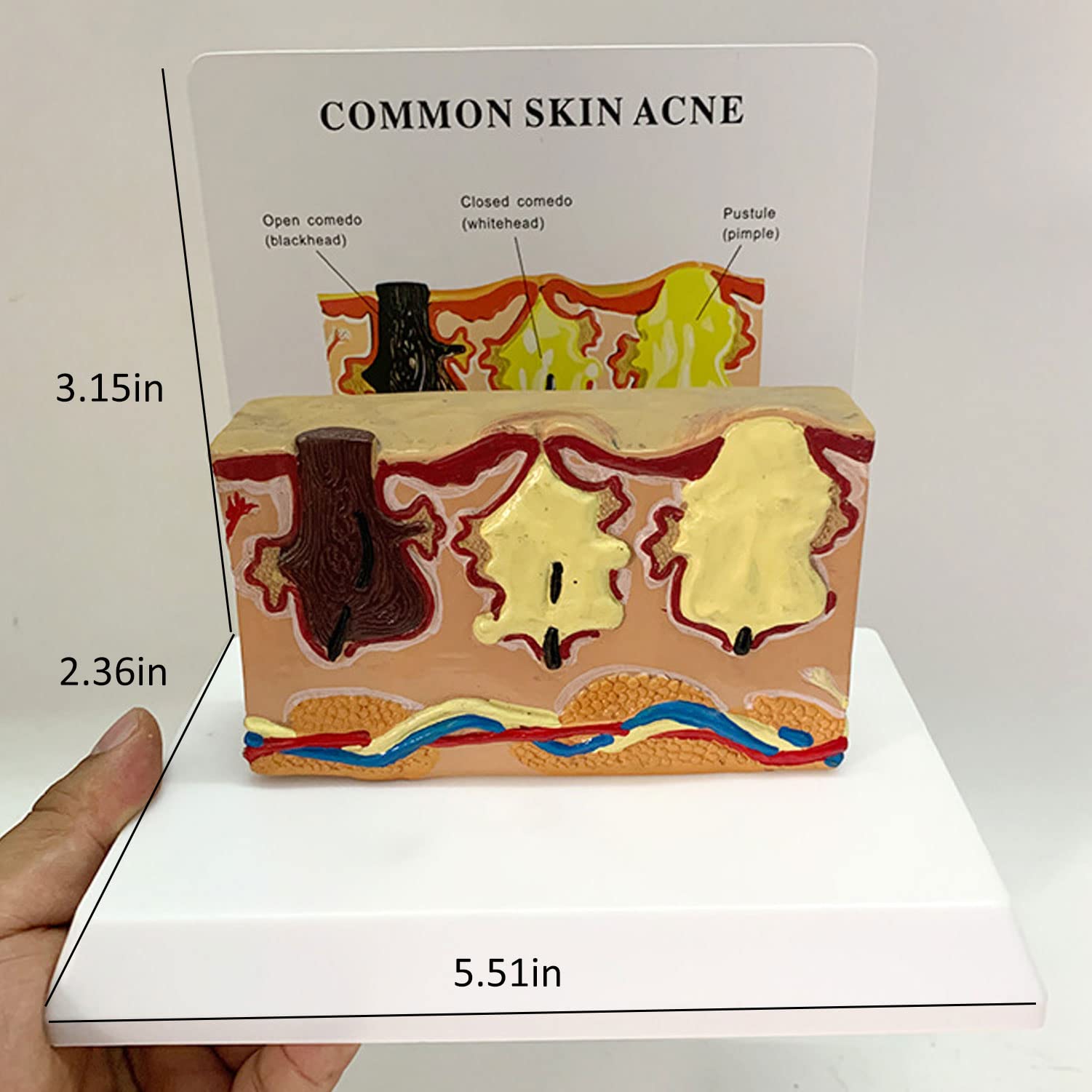 Anatomía Del Acné Acné Y Rosácea: Diagnóstico Y Tratamiento
