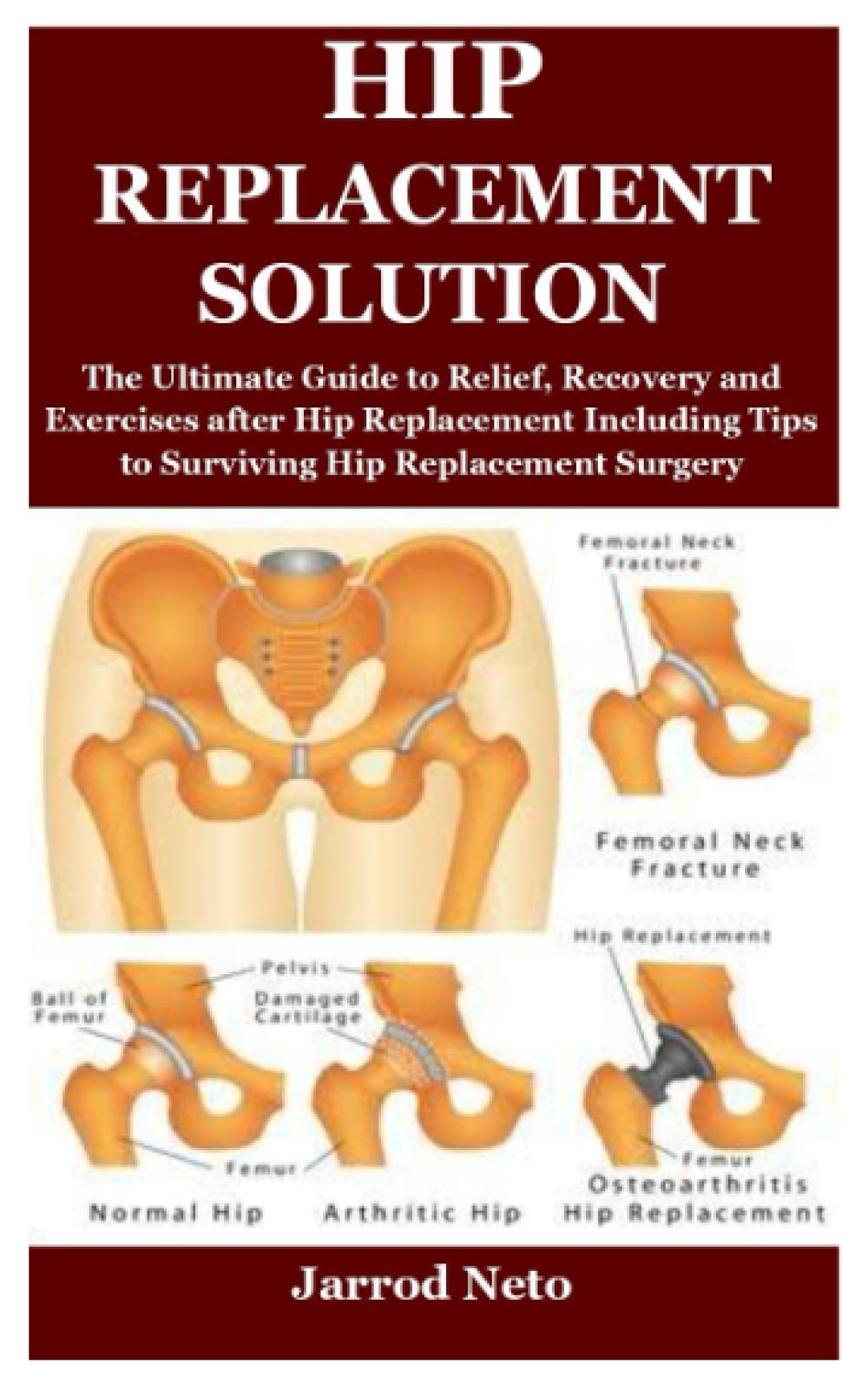 Buy HIP REPLACEMENT SOLUTION: The Ultimate Guide to , Recovery and ...
