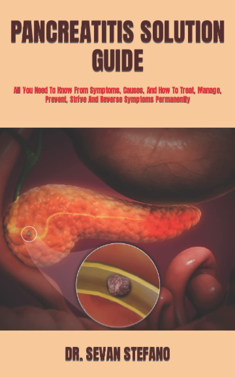 Pancreatitis Solution Guide All You Need To Know From Symptoms ...
