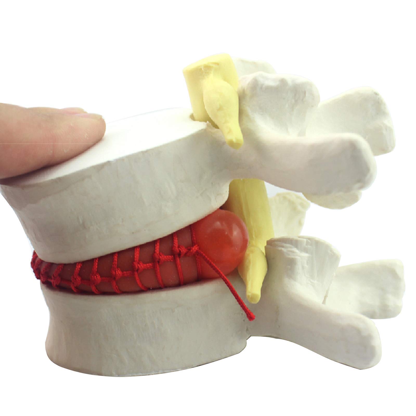 Zhangyy Human Lumbar Disc Herniation Model Anatomical Human Lumbar ...