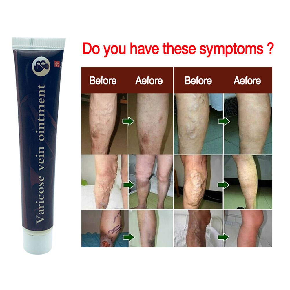 Buy Varicose Veins Cream Varicose Veins Cream, Phlebitis Vasculitis ...