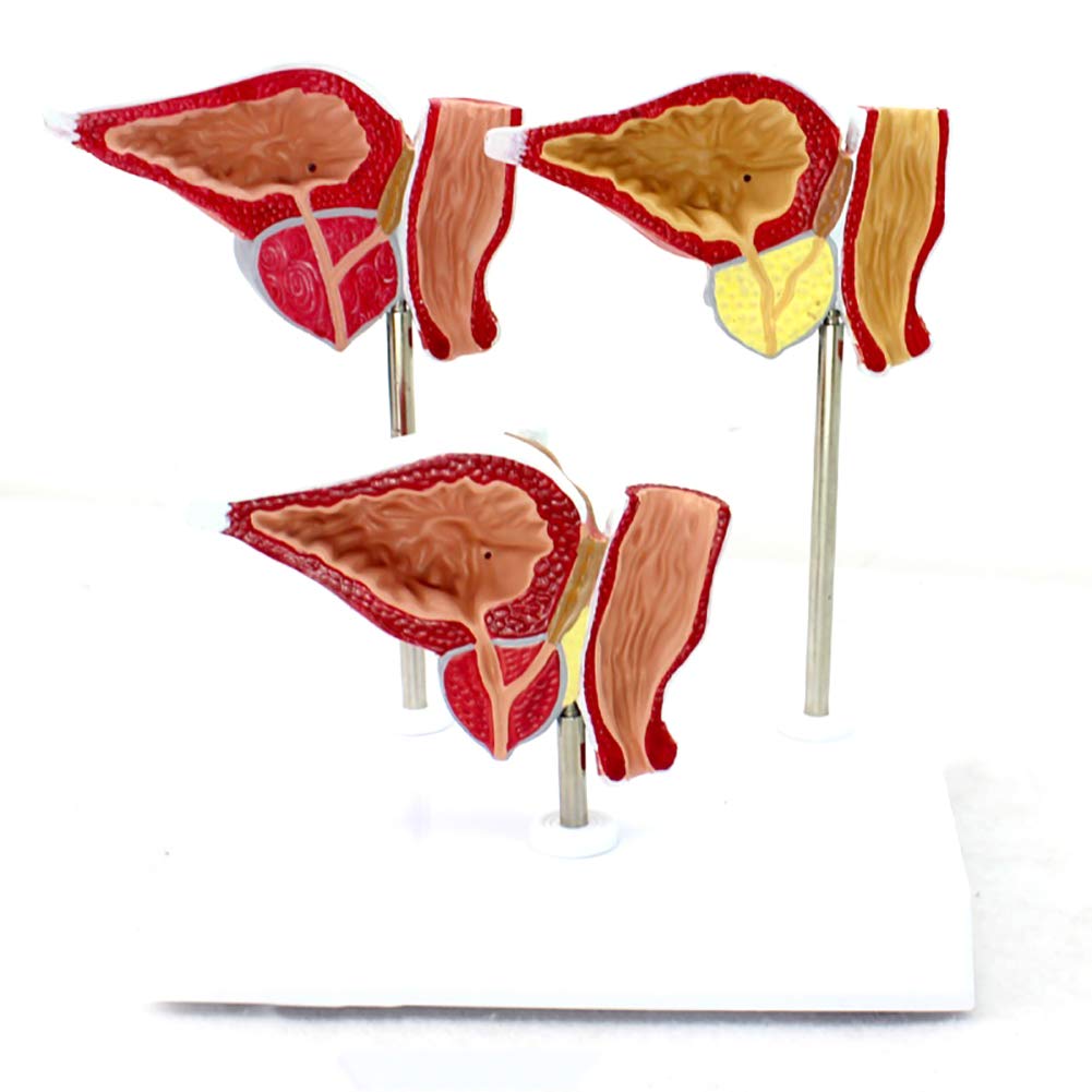 Buy Prostate Model Bph Prostatic Hyperplasia Anatomical Mode Showing Three States Normal