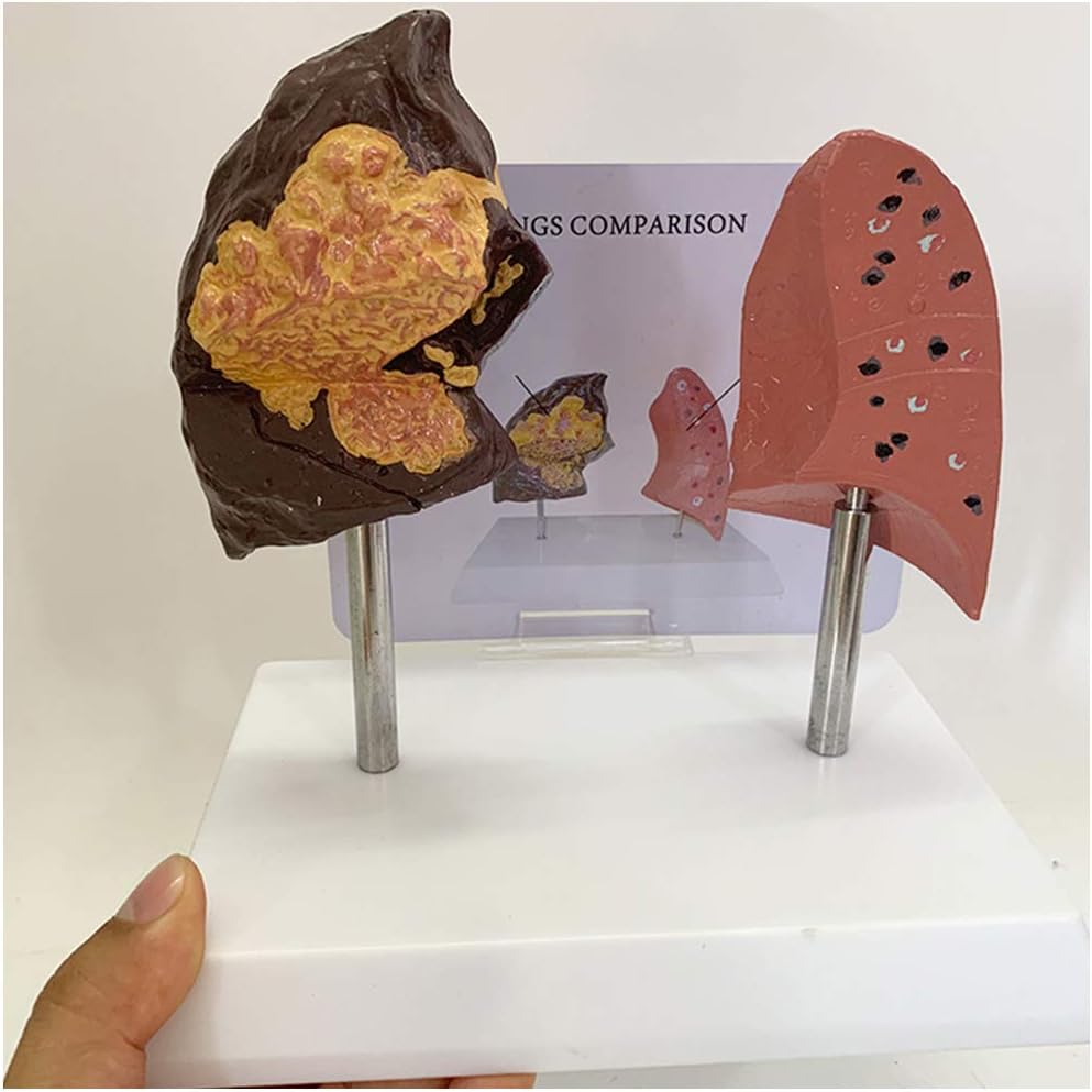 Modelo de comparación de pulmón sano y pulmón patológico - Modelo de ...