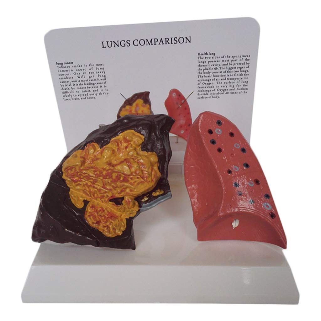 Lung Anatomy Model Human Lung Model Smoking Lung And Normal ...