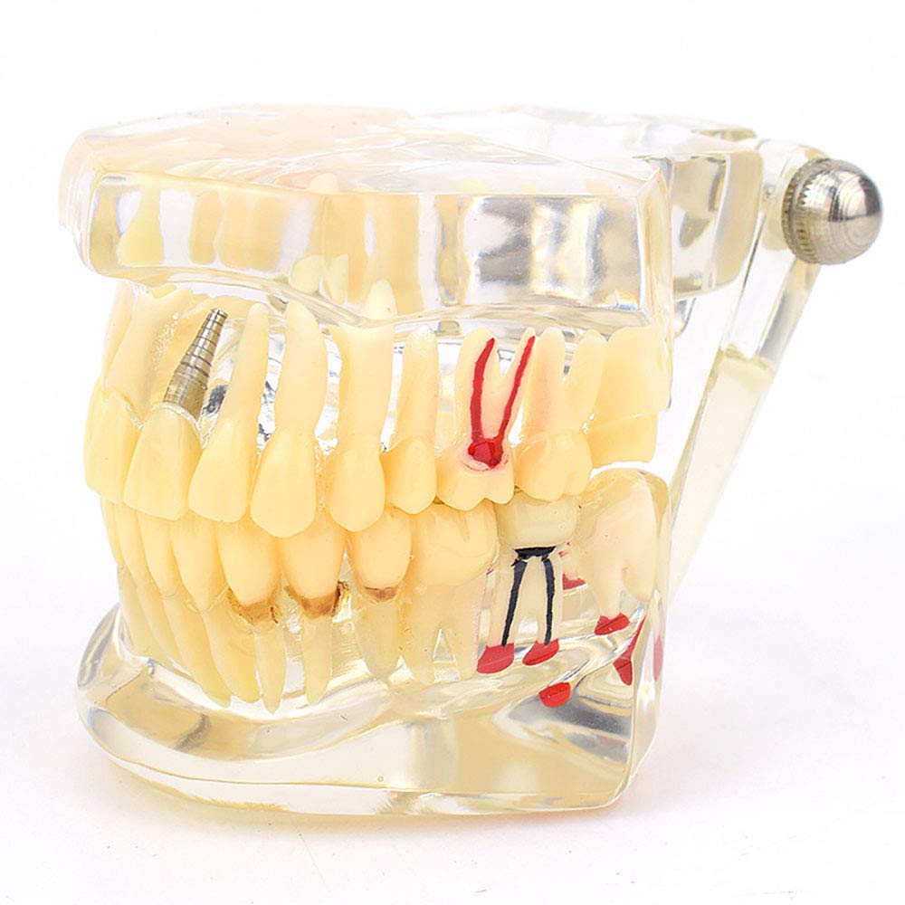 Buy Dental Tooth Model, Dental Demonstration teeth Model, Restoration ...