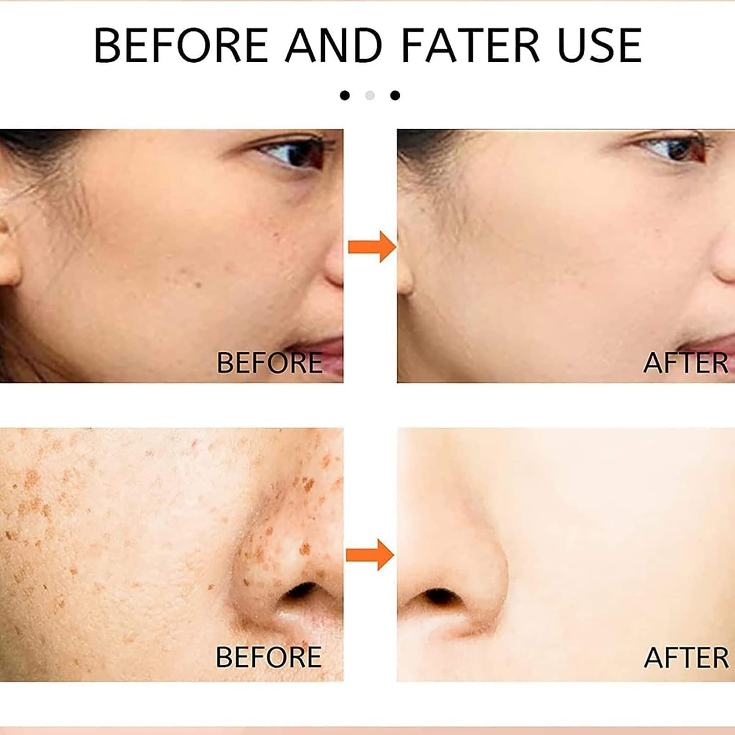chouqin Hoshi Cream Japan, crema de melasma japonesa, crema de manchas ...