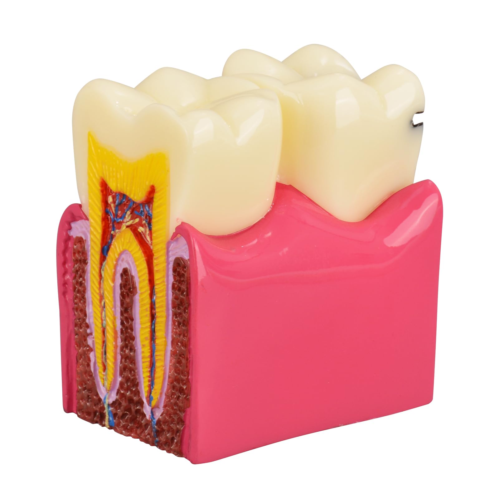 Snapklik.com : Ultrassist Dental Tooth Decay Model 6 Times Dental ...