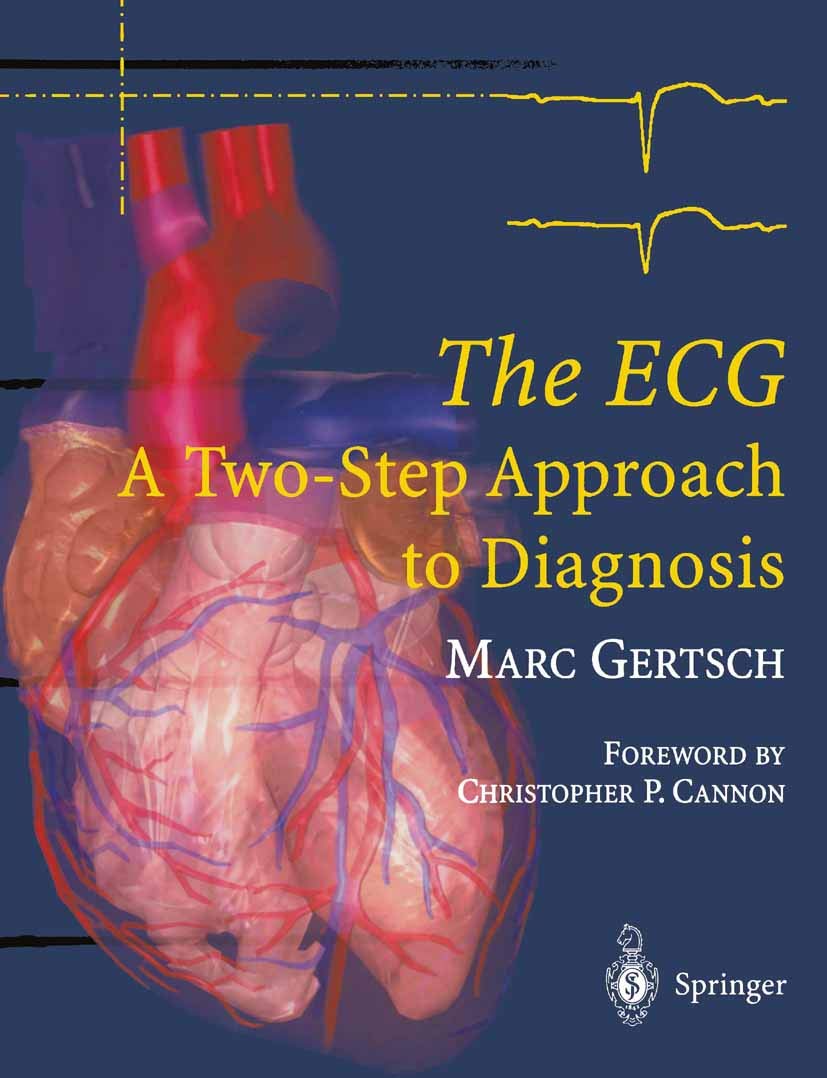 The Ecg A Two Step Approach To Diagnosis 2004th Edition | Desertcart ...