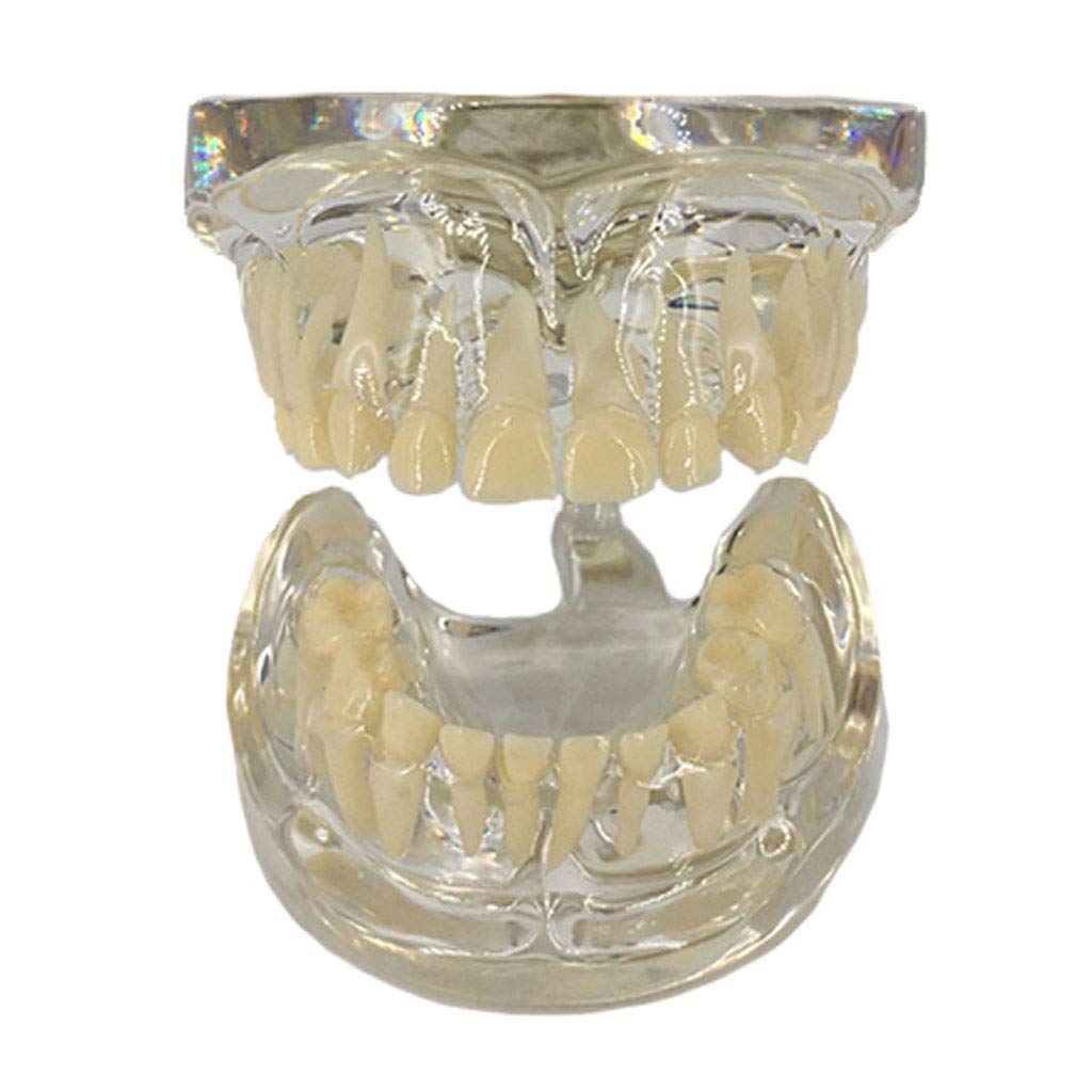 Dongbala Child Tooth Model Deciduous Tooth Model Dental Caries ...