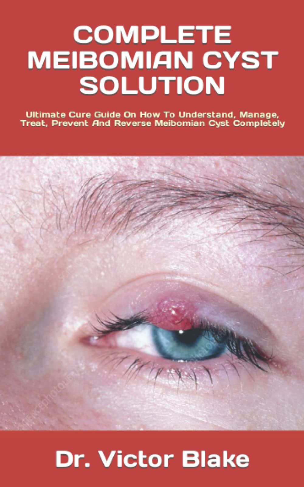 Complete Meibomian Cyst Solution Ultimate Cure Guide On How To ...