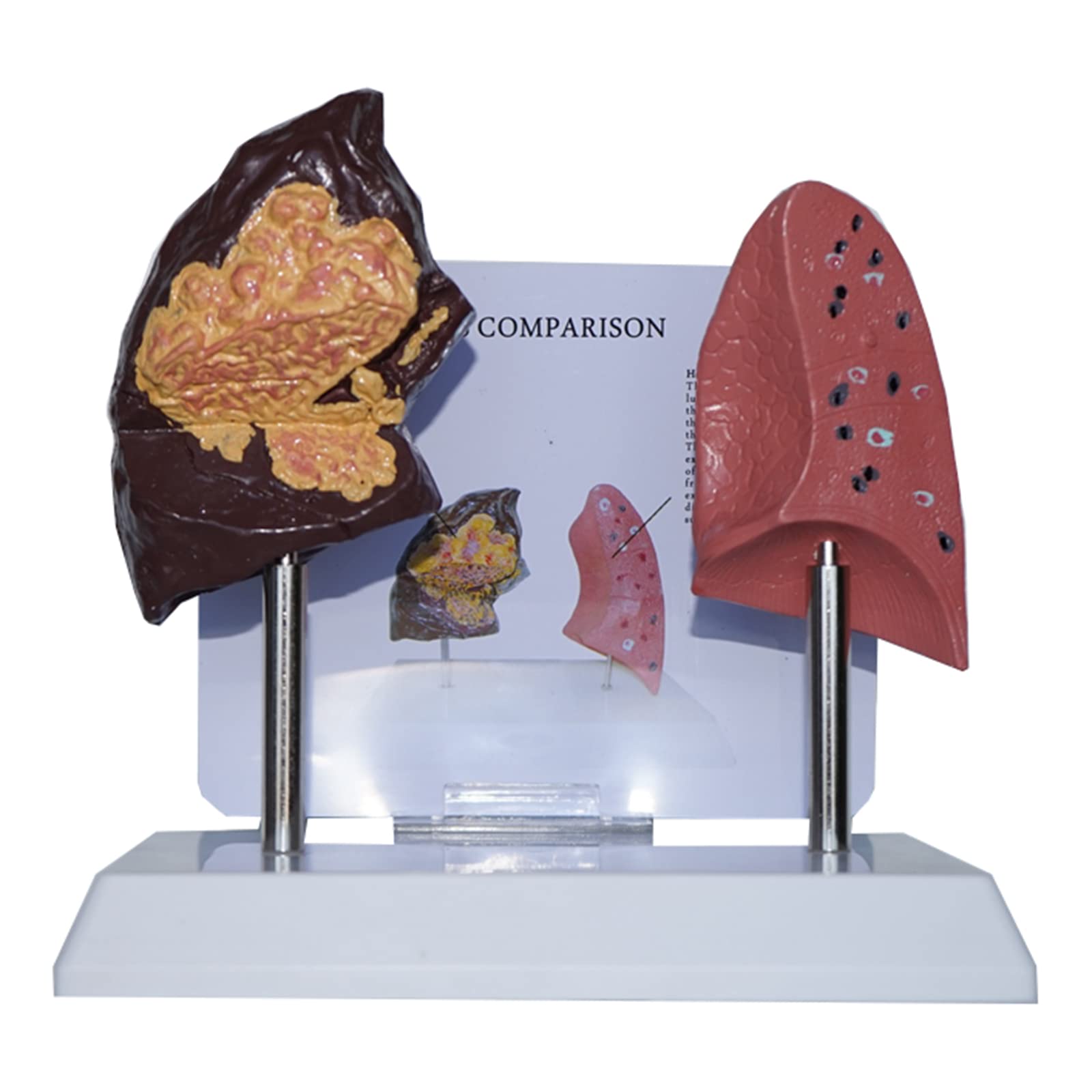 Smokers Lung Comparison