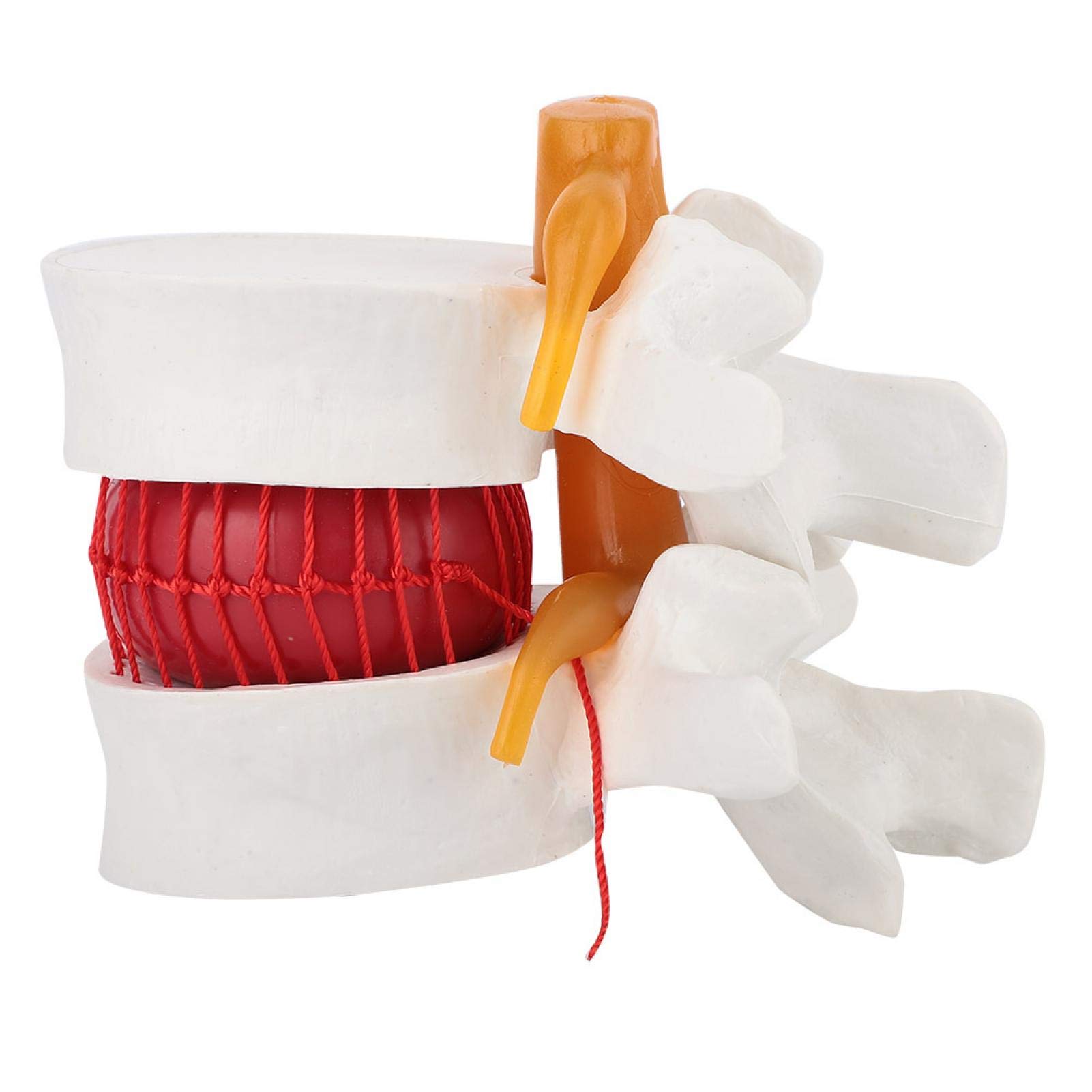 Buy 1 1 5 Anatomical Human Disc Herniation Model Vertebras Anatomicas buy-1-1-5-anatomical-human-disc-herniation-model-vertebras-anatomicas