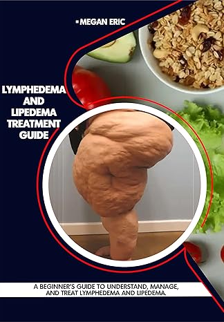 Lymphedema and Lipedema Treatment Guide: A Beginner's Guide to ...