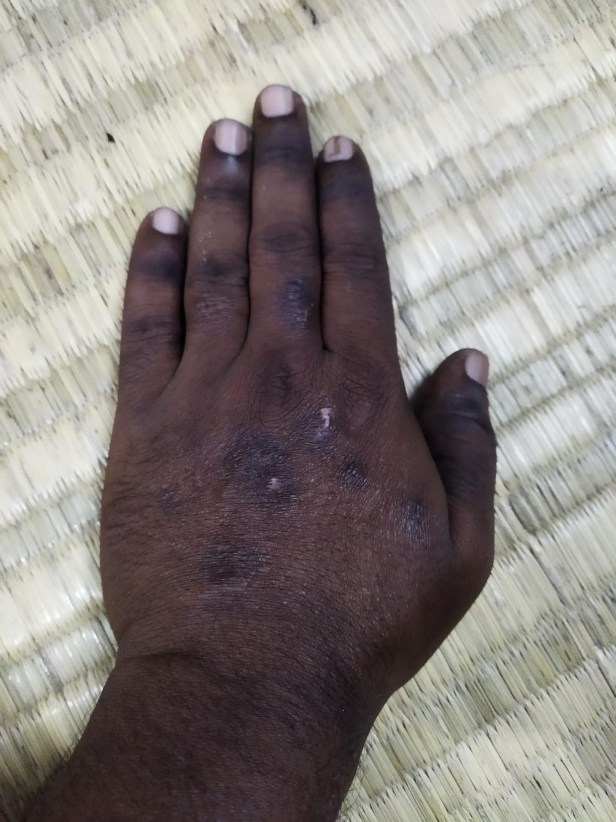 Buy Lecor & Livcon Capsule, For Vitiligo, White Patches Online at Low ...