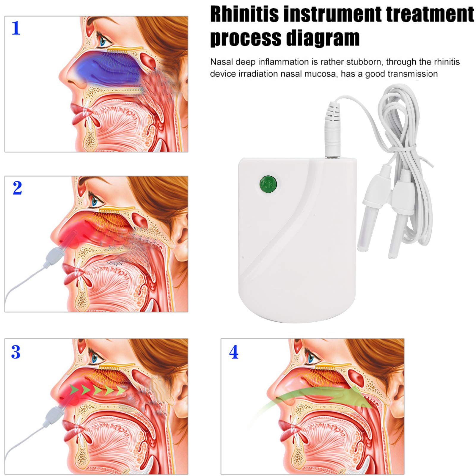 Nasal Mucosa Repair Anti-inflammatory Device, Rhinitis Laser Therapy ...