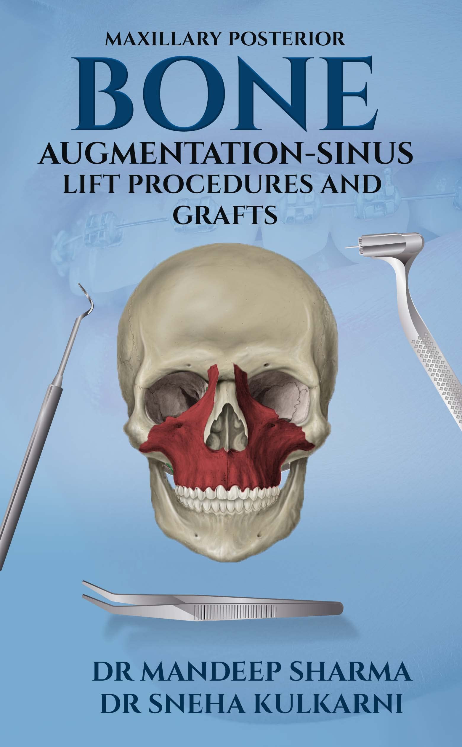Maxillary Posterior Bone Augmentation Sinus Lift Procedures And Grafts ...