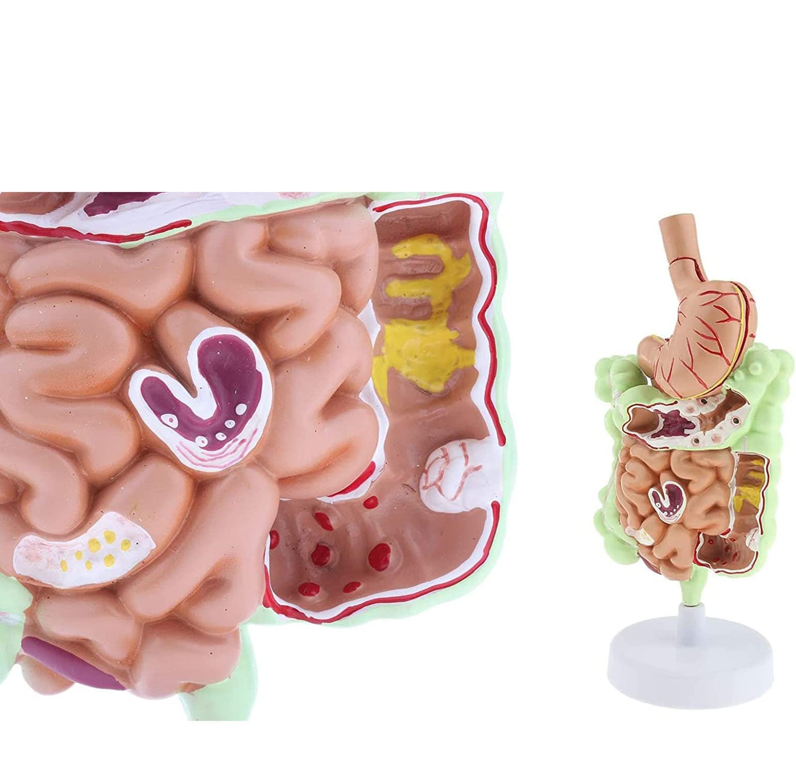 Buy Human Large Intestine Pathological Model trointestinal Anatomical ...