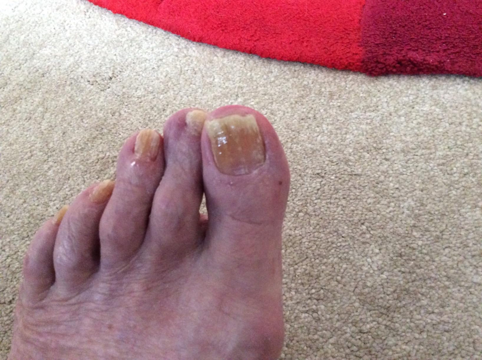 medosan MedoNail Fungal Nail Treatment Liquid Swiss Formula : Amazon.co ...