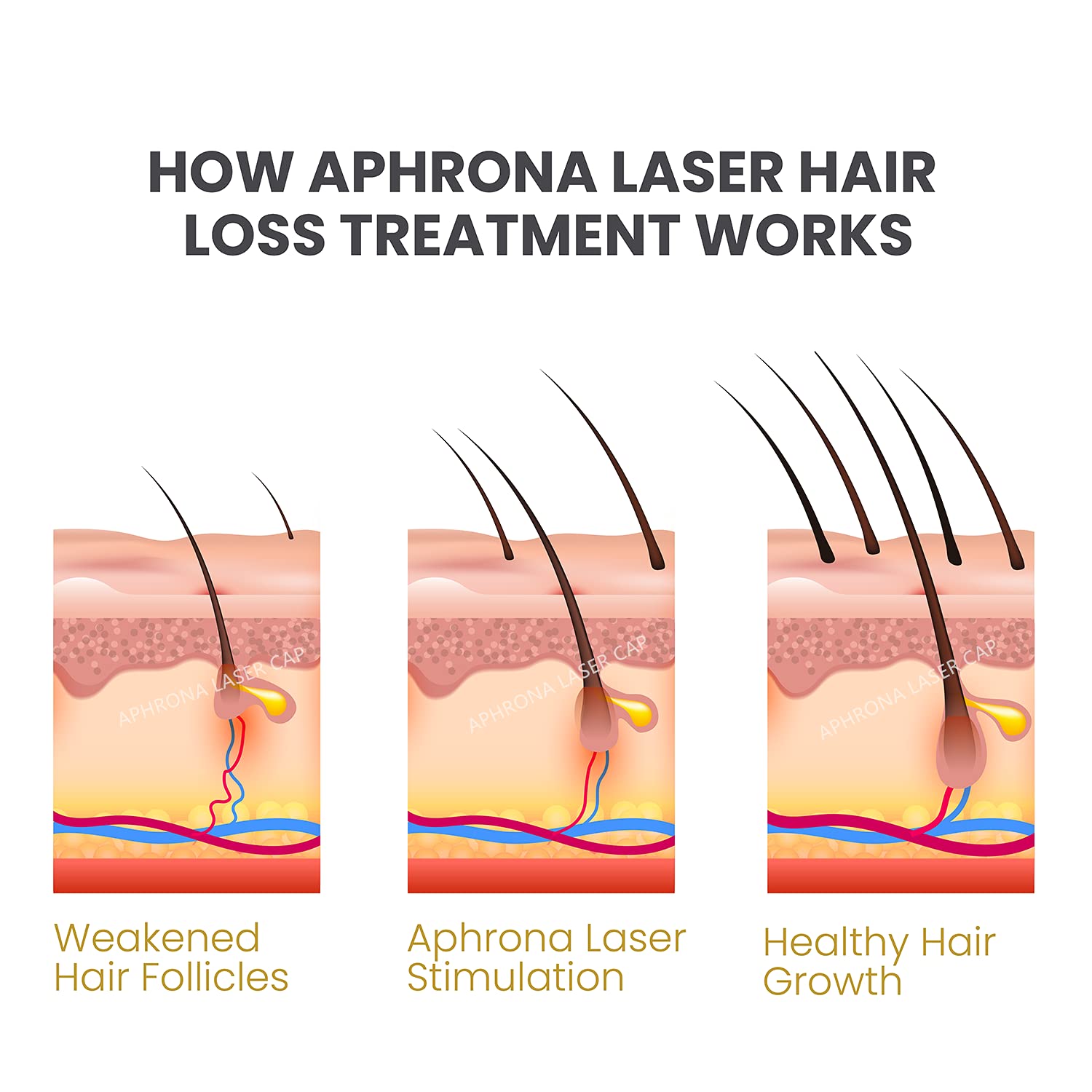 Buy Aphrona® Advanced Hair Growth System 272 HairPro for Men and Women ...