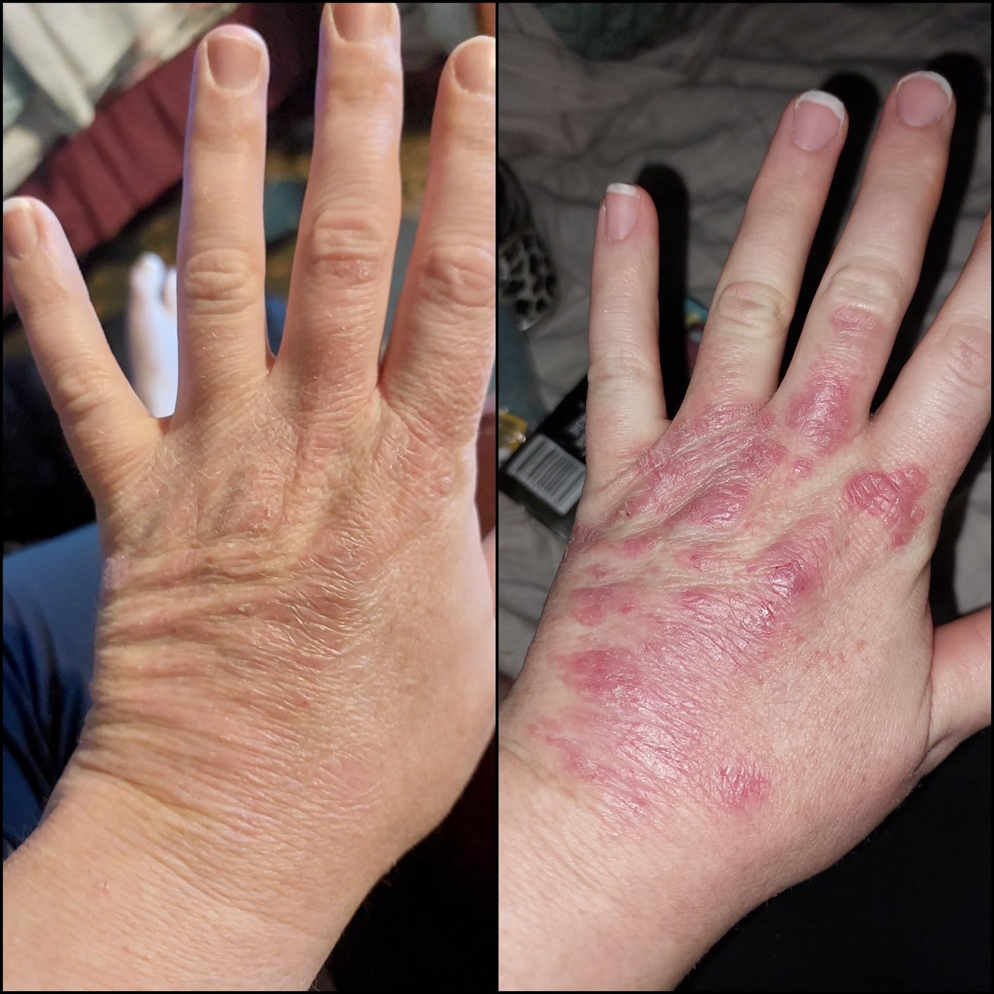 Dermfix 1000MX UV-B Lamp for Psoriasis, Vitiligo or Eczema : Amazon.com ...