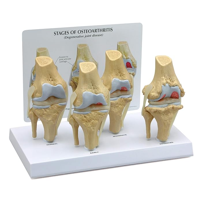 Buy Knee Joint Model Set | Human Body Anatomy Replica Set of 4-Stage ...