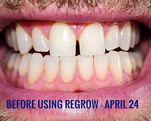 Amazon.com : REGROW Remineralizing Tooth Powder - Whiter Teeth ...