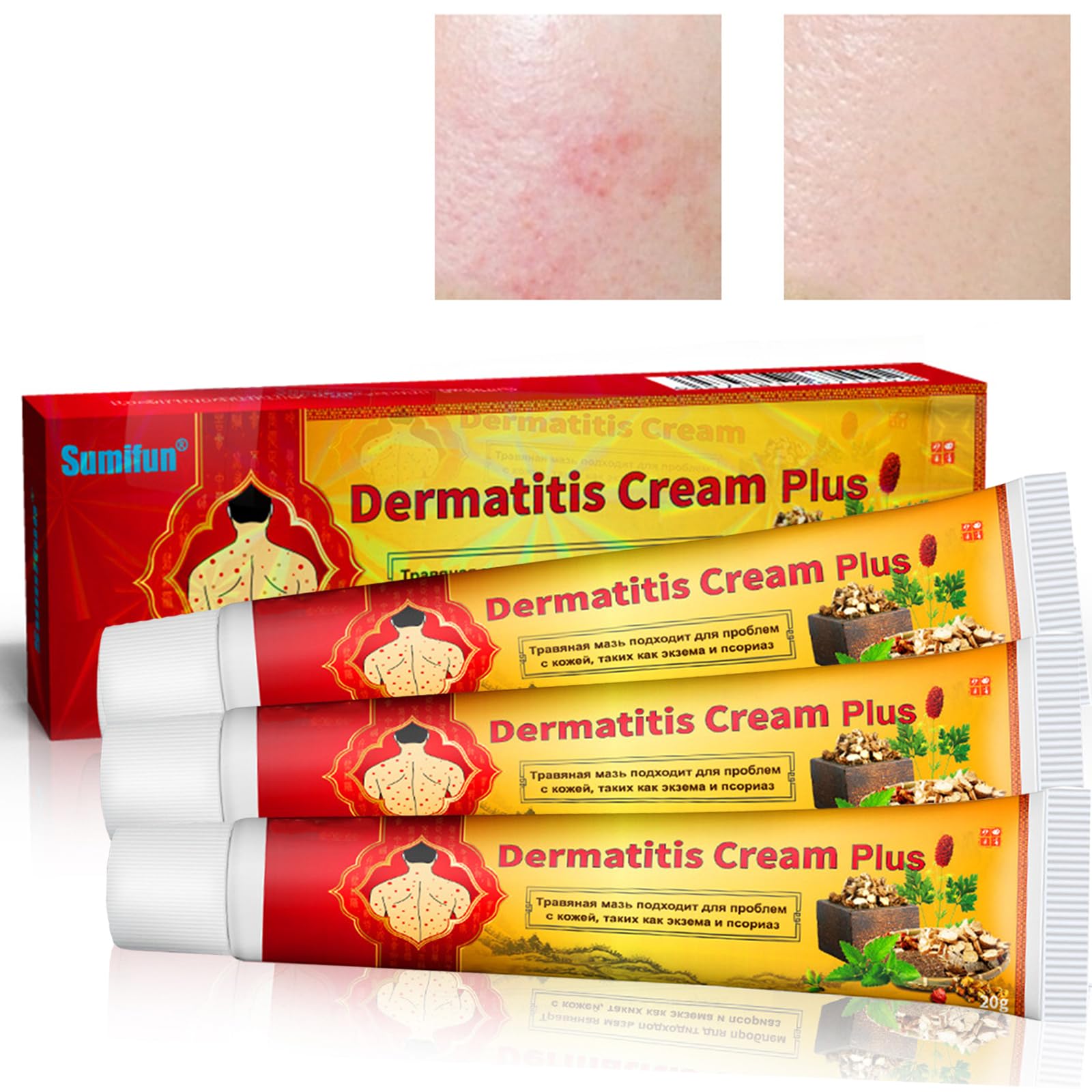 3PC Antifungal Cream Dermatitis Cream Eczema Cream, Antifungal Cream ...