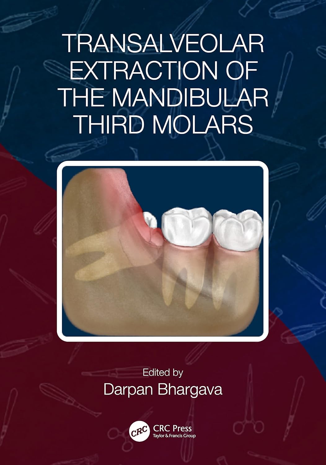 Buy Transalveolar Extraction of the Mandibular Third Molars Book Online ...