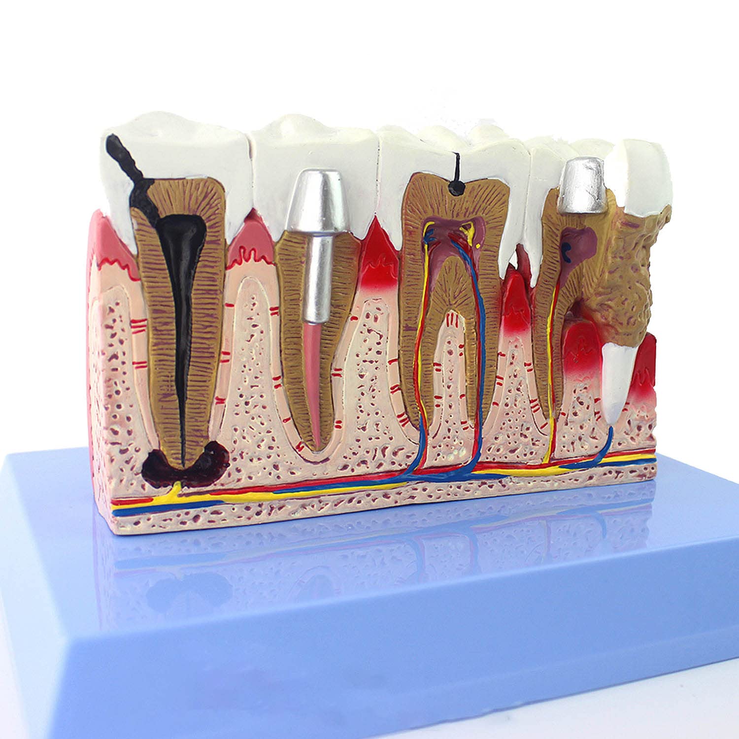 Buy CHUANGRUN Dental Caries Teeth Model, Dental Teeth Teaching Model ...