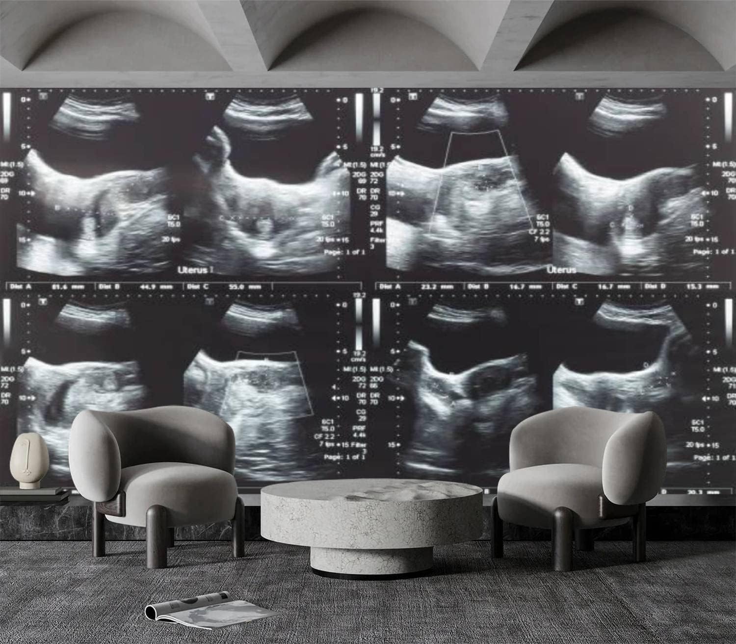 Vintage Ultrasound image of lower abdomen ovary and uterus with tumor ...