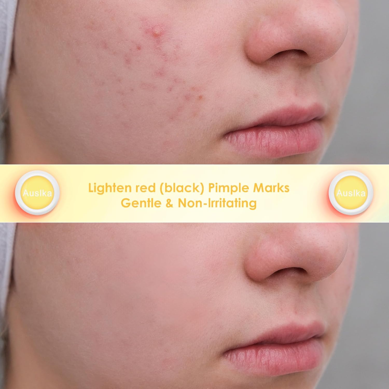 AUSLKA Light Therapy Pimple Patch, LED Red Light Bahrain | Ubuy