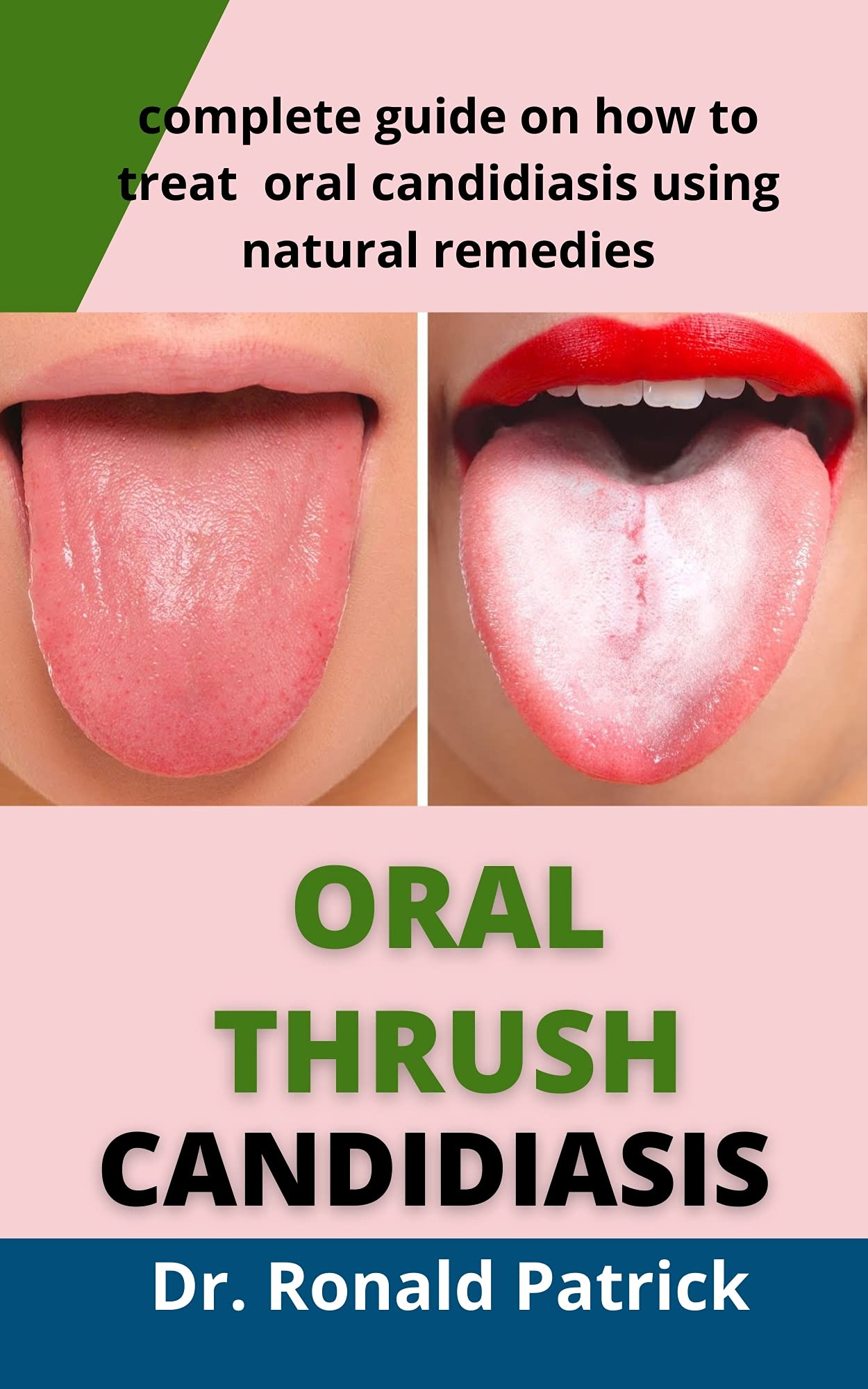 Buy ORAL THRUSH CANDIDIASIS: Complete Guide on How to Treat Oral ...