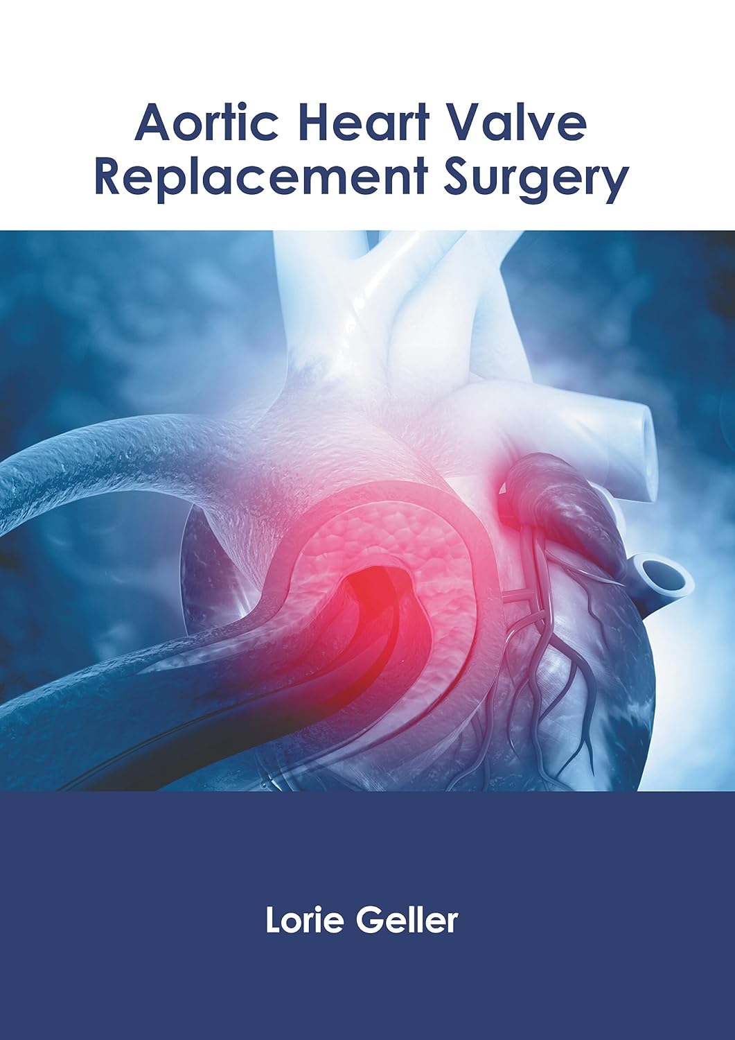 Aortic Heart Valve Replacement Surgery: Geller, Lorie: 9781639278930 ...