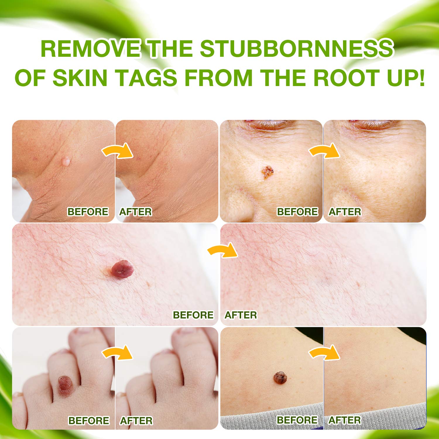 Buy Ulensy Skin Tag Remover - Extra Strength Skin tag Removal Liquid ...