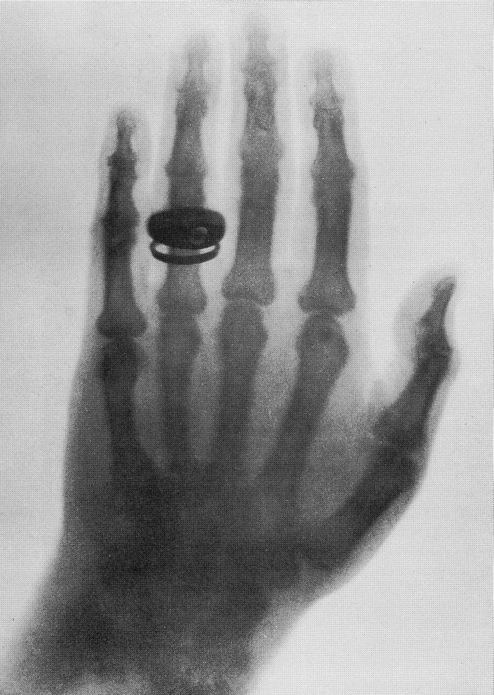 Amazon.com: Wilhelm Roentgen X-ray 1896 Poster Print by Science Source ...