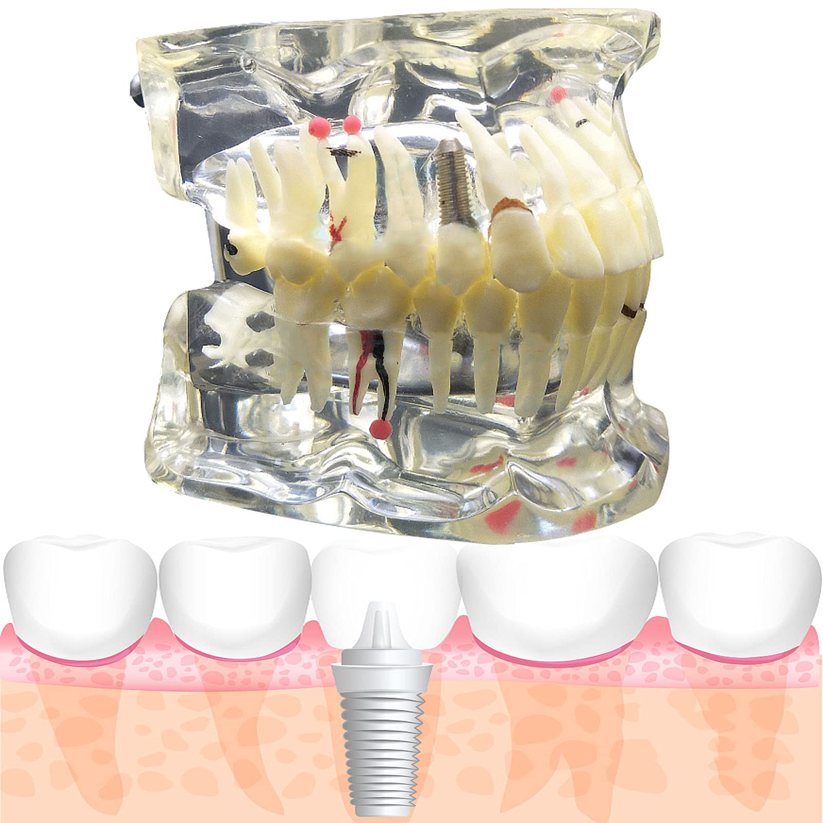 Buy Dental Crown Models, Dental Teeth Model, Teeth Model Im Caries ...