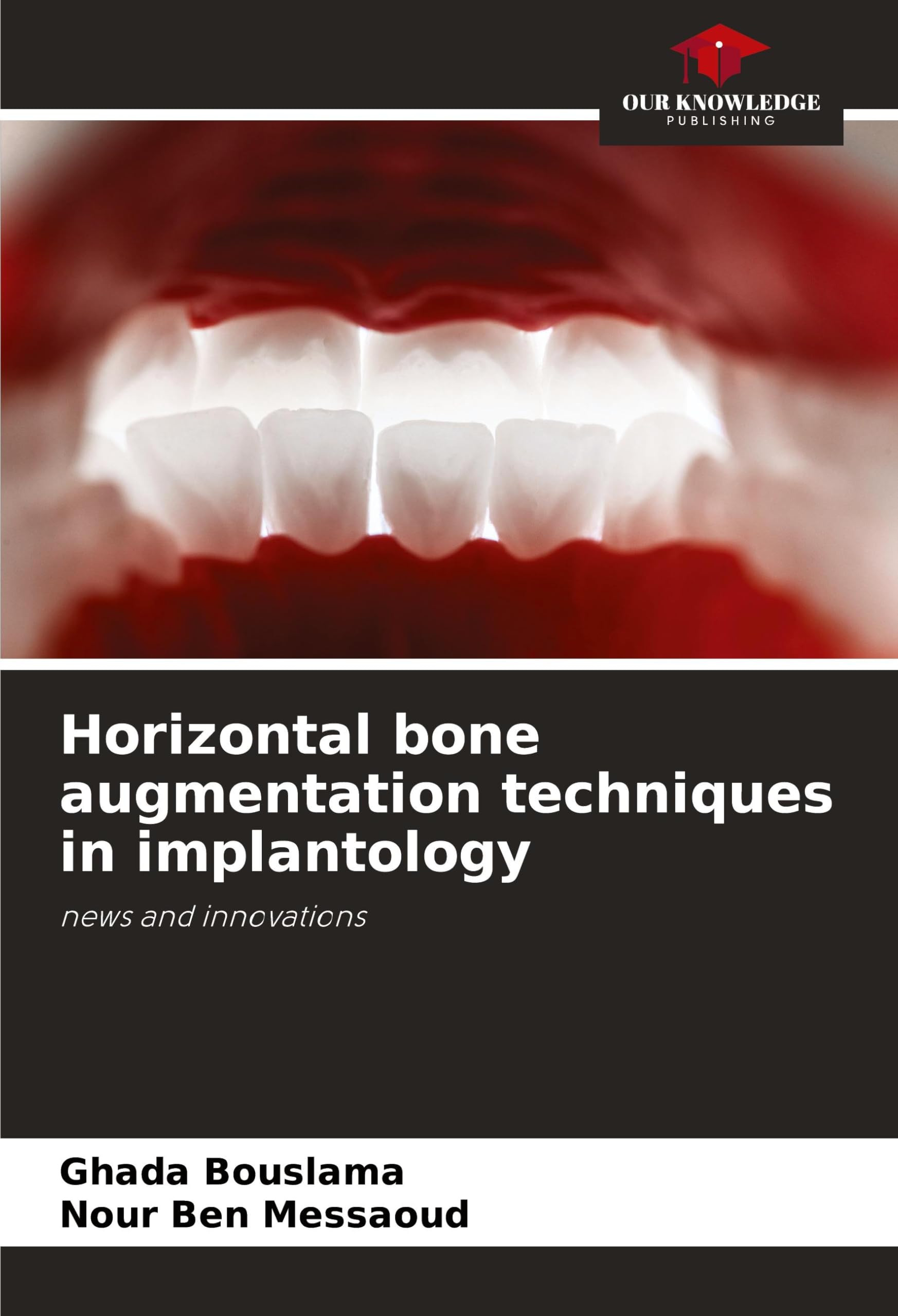 Buy Horizontal bone augmentation techniques in implantology Book Online at Low Prices in India ...