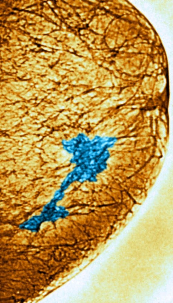 Amazon.com: Mammogram Poster Print by Science Source (24 x 36): Posters ...