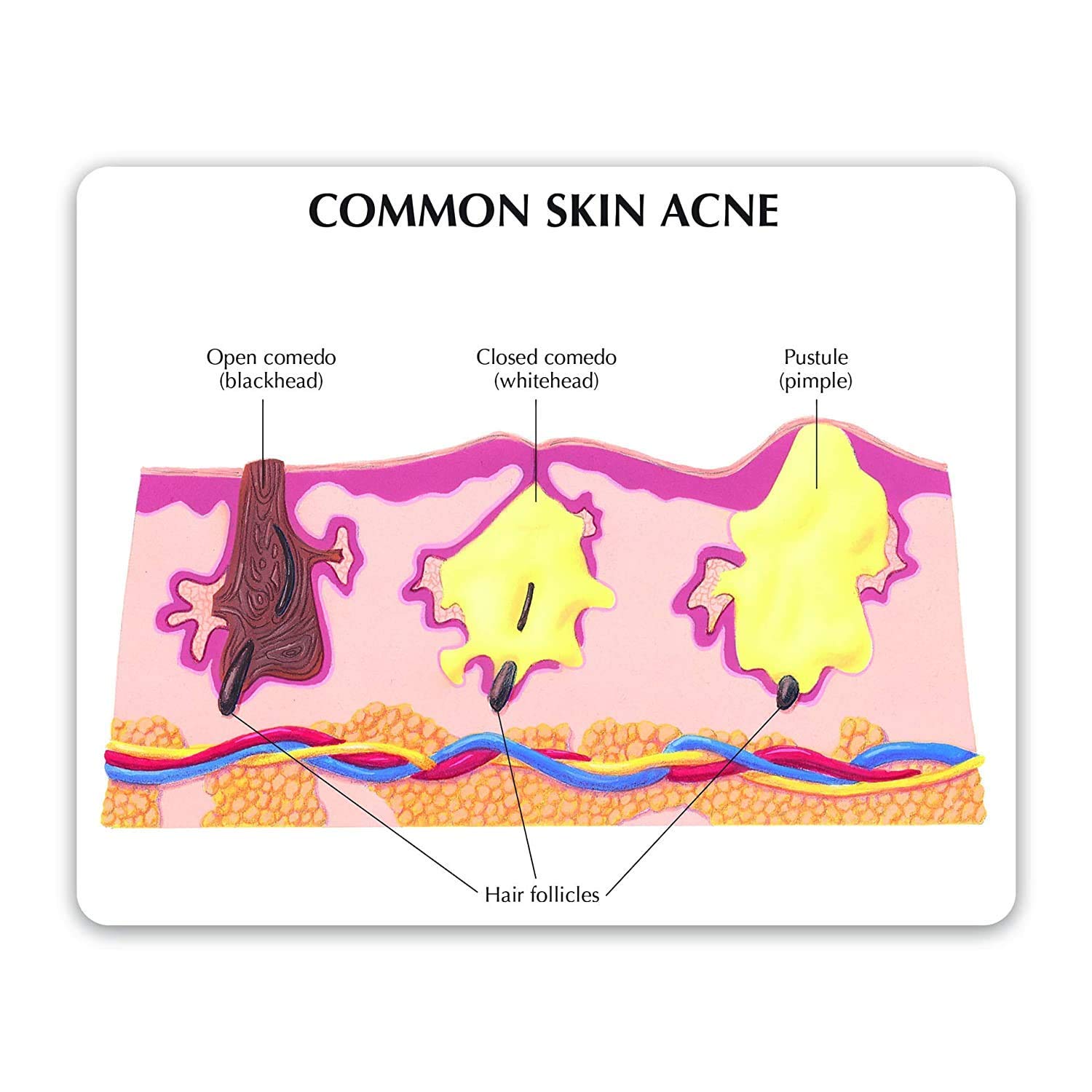 Blackhead Cross Section 274 Acne Skin Cross Section Images, Stock