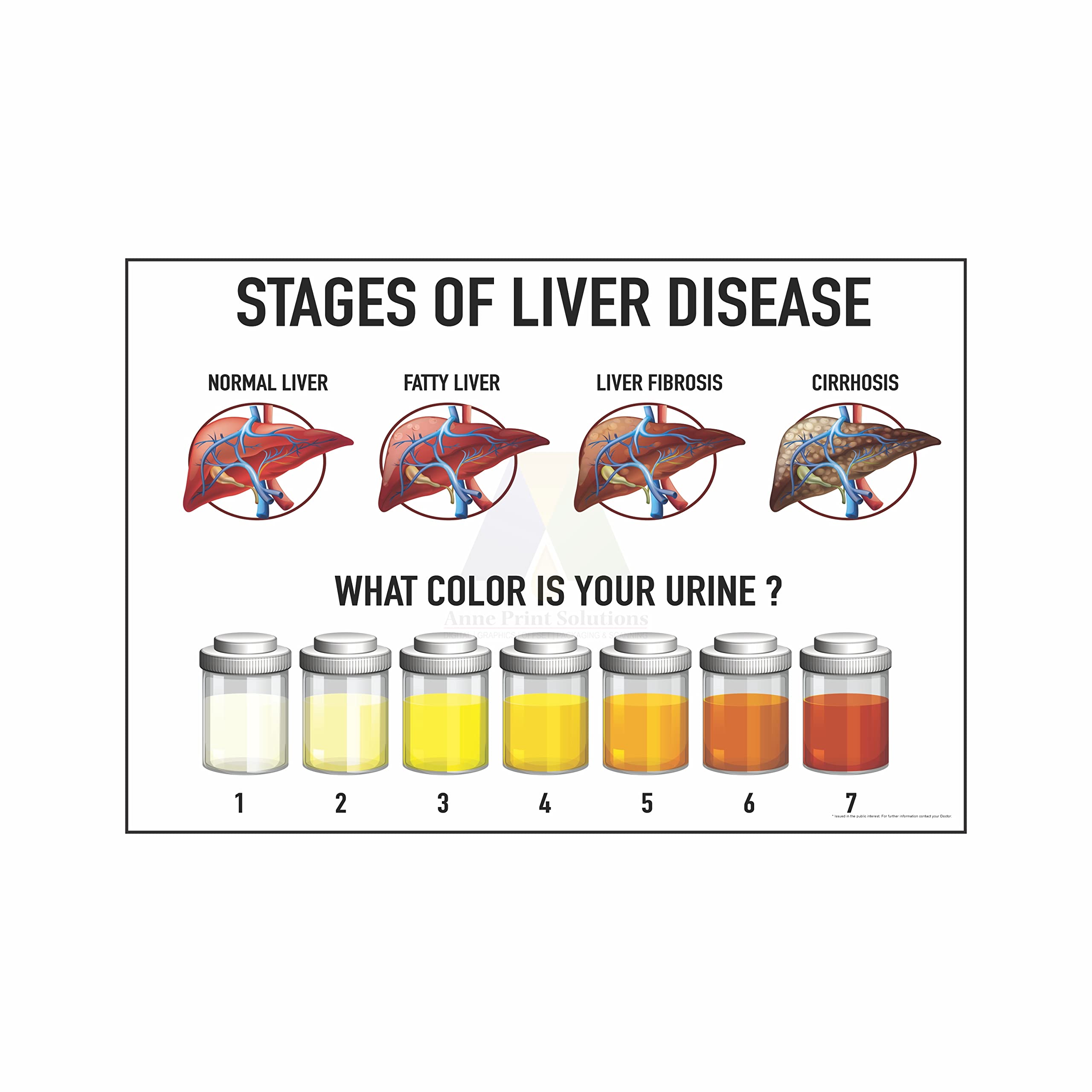 Anne Print Solutions® Stages of liver disease Poster (Without Frame ...