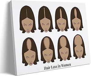Amazon.com: CDDYQBN Female Hair Loss Chart Hair Loss Reference ...