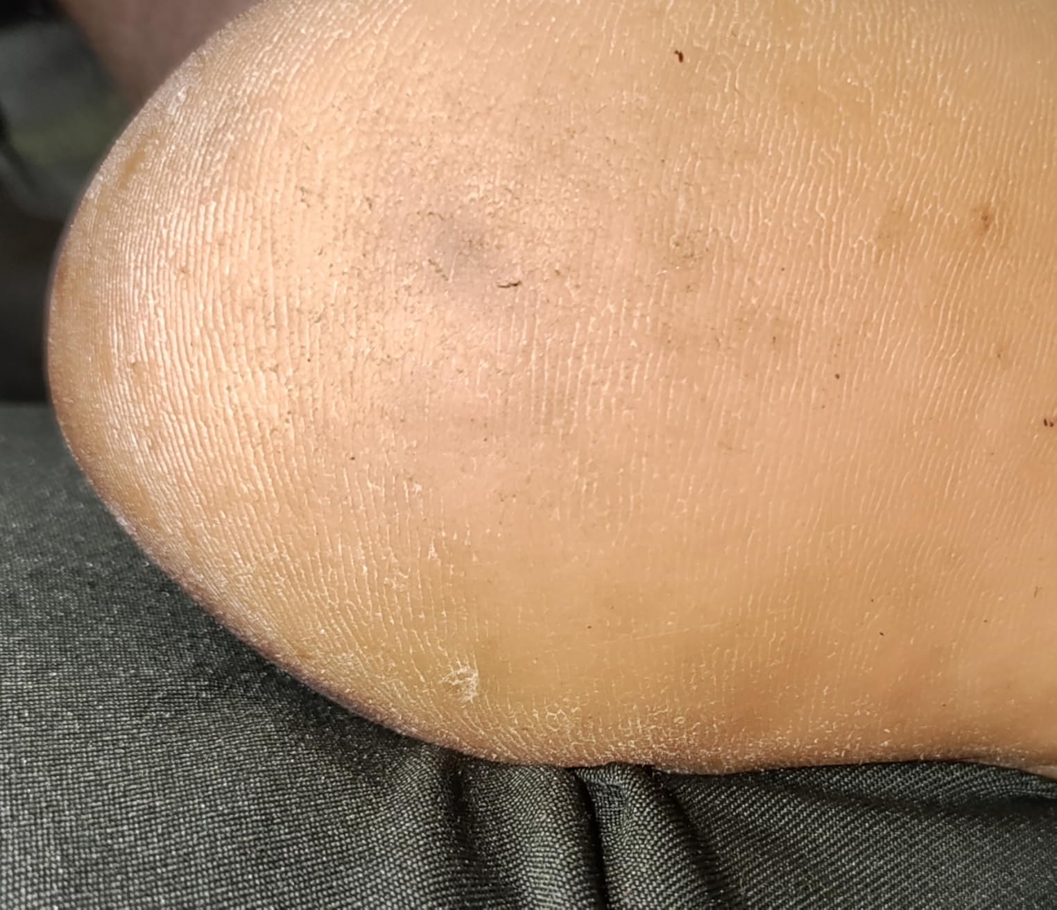 Buy Leeford Cornex Corn Cap, Corn Remover for Feet-Combo 20 Strips ...