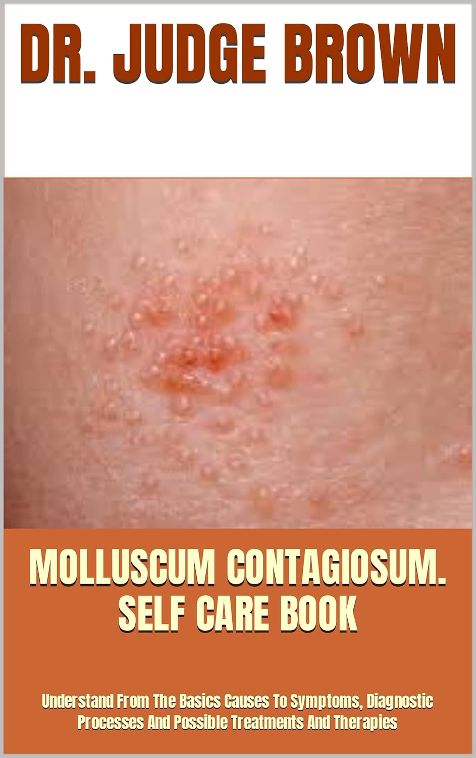Amazon.co.jp: MOLLUSCUM CONTAGIOSUM. SELF CARE BOOK : Understand From ...